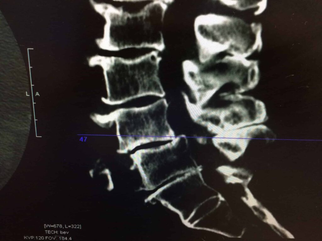 C1 and C2 Vertebrae Misalignment Symptoms
